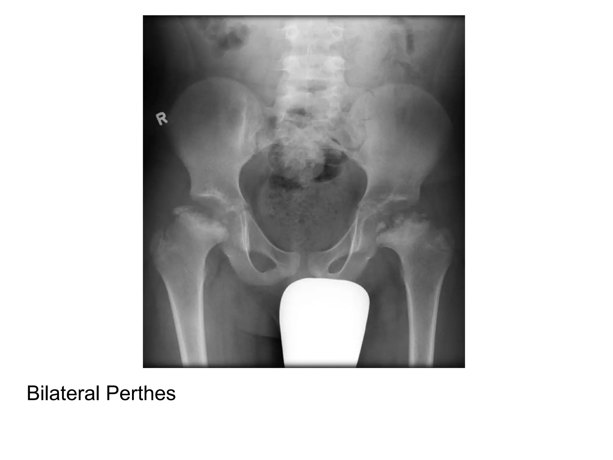 Diagnostic Imaging of Pediatric Hip Lesions | PPT