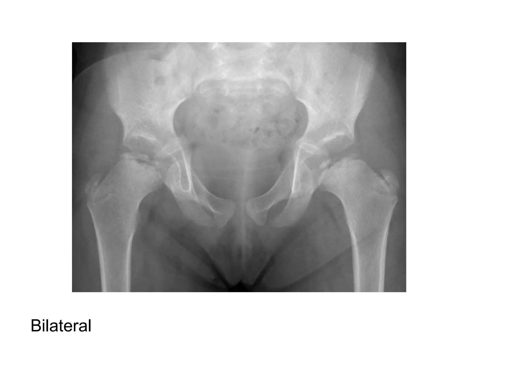 Diagnostic Imaging of Pediatric Hip Lesions | PPT