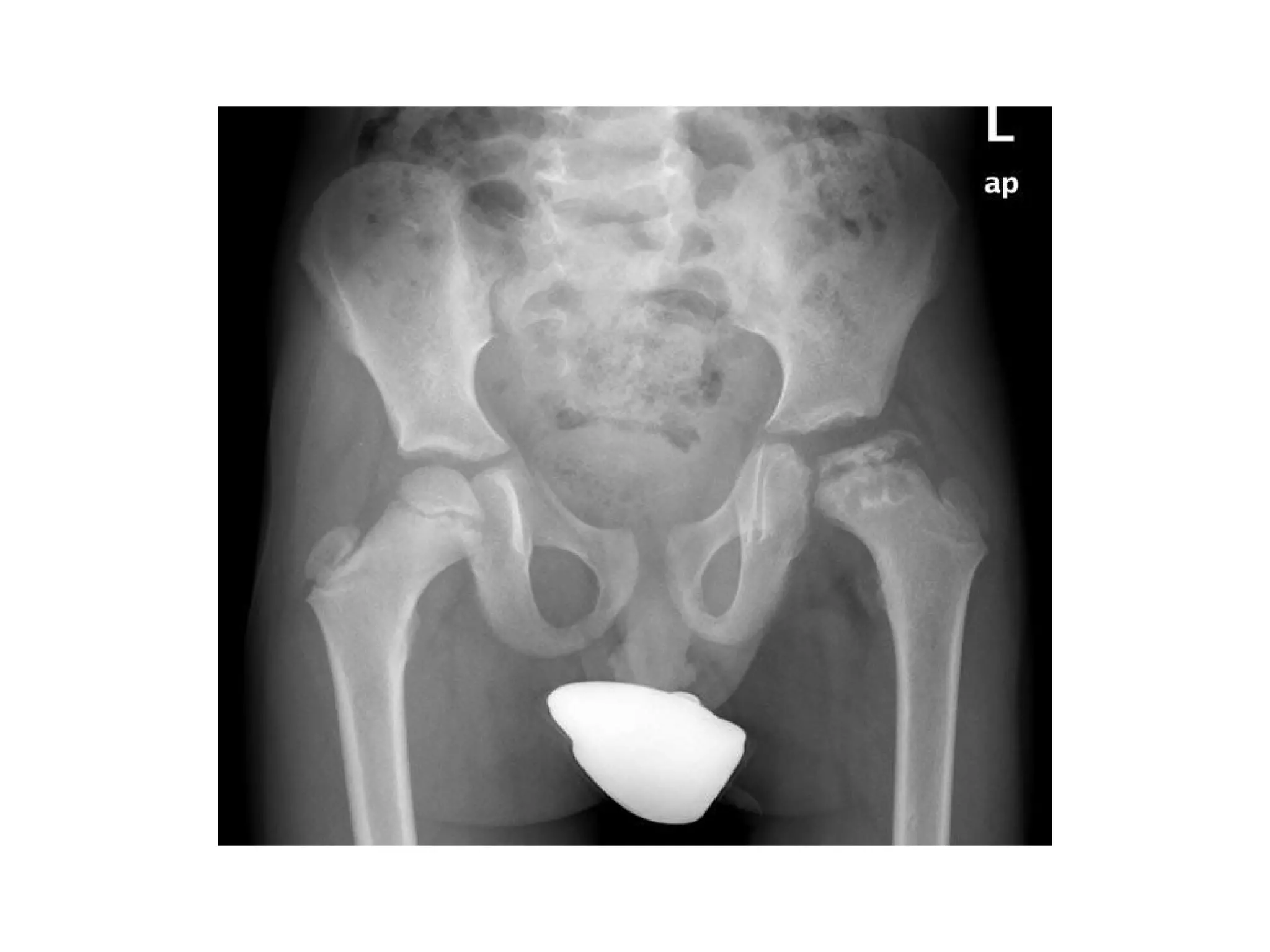 Diagnostic Imaging of Pediatric Hip Lesions | PPT