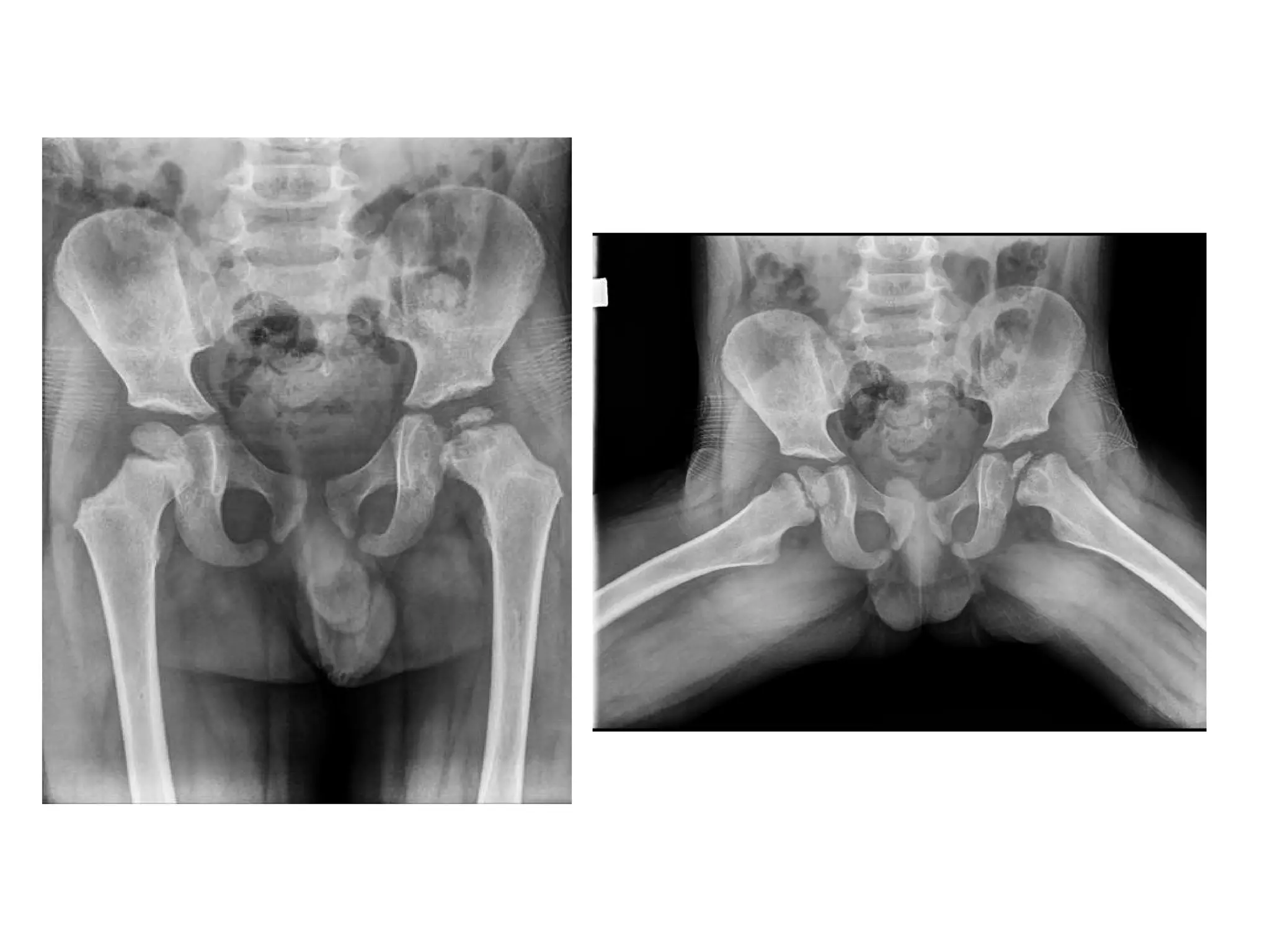 Diagnostic Imaging of Pediatric Hip Lesions | PPT
