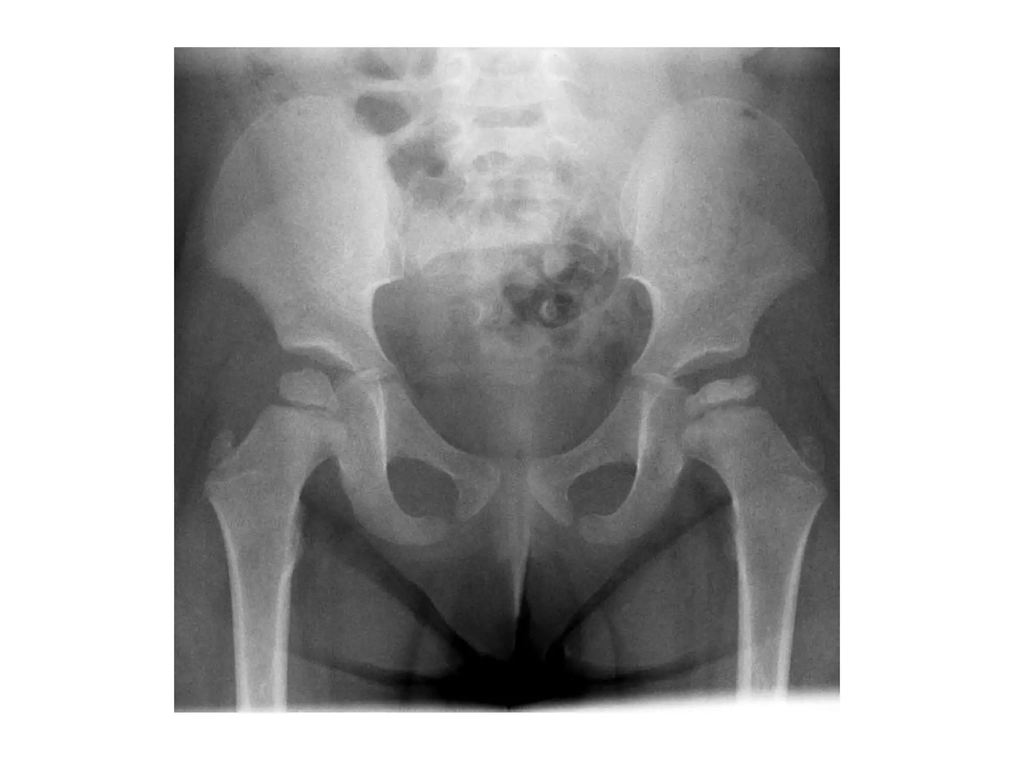 Diagnostic Imaging of Pediatric Hip Lesions | PPT