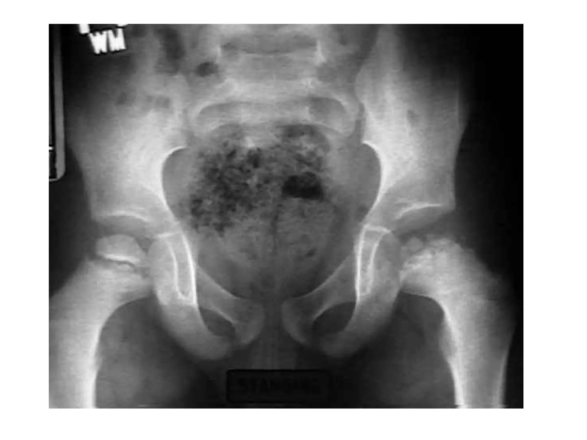 Diagnostic Imaging of Pediatric Hip Lesions | PPT
