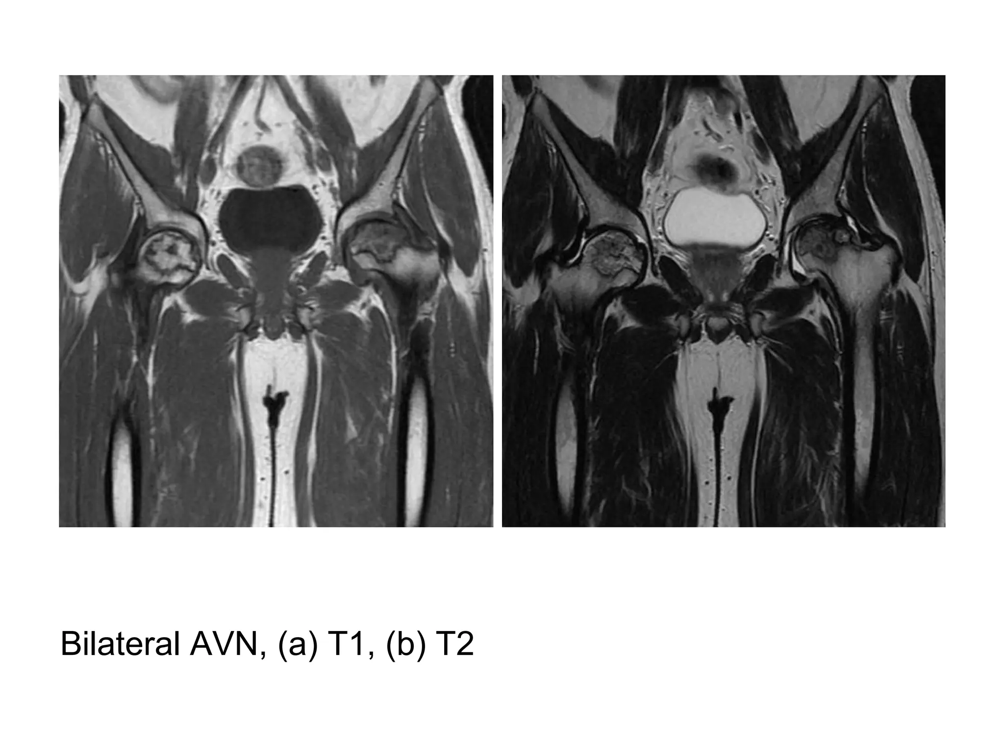 Diagnostic Imaging of Pediatric Hip Lesions | PPT