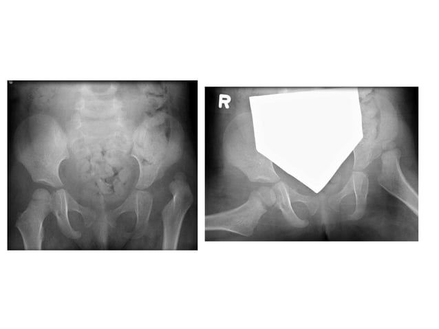 Diagnostic Imaging of Pediatric Hip Lesions | PPT
