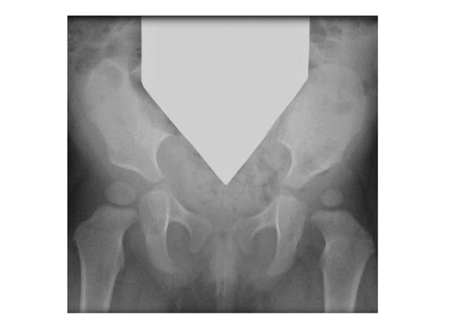 Diagnostic Imaging of Pediatric Hip Lesions | PPT