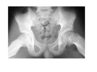 Diagnostic Imaging of Pediatric Hip Lesions | PPT