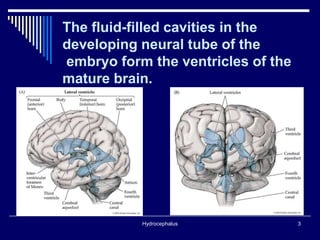 Hydrocephalus | PPT