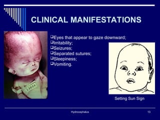 Pediatric Hydrocephalus Treatment and Diagnosis | PPT