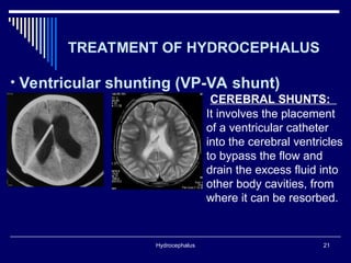 Pediatric Hydrocephalus Treatment and Diagnosis | PPT