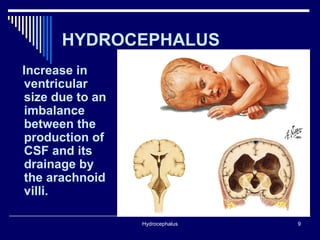 Pediatric Hydrocephalus Treatment and Diagnosis | PPT