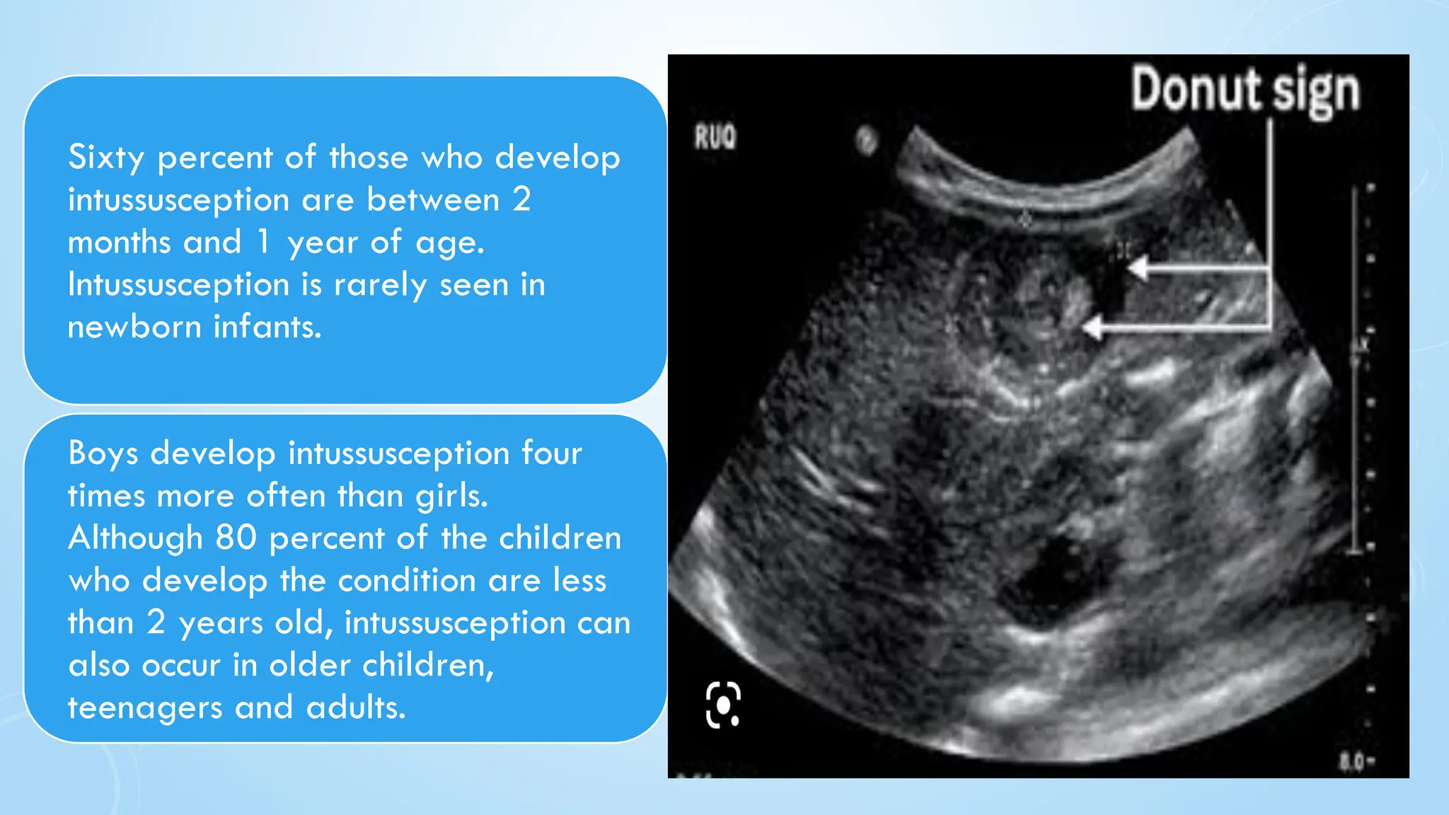 case of pediatric intestinal intussception.pptx