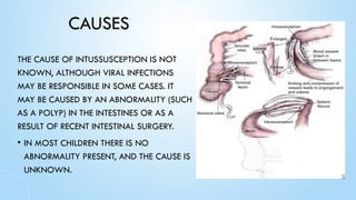 case of pediatric intestinal intussception.pptx