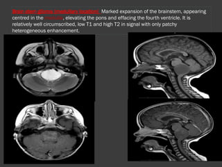 pediatric intracranial masses 7-10-2024.ppsx
