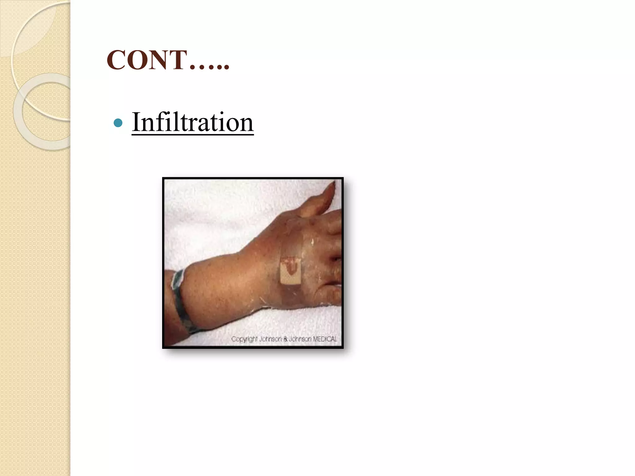Pediatric intravenous cannulation | PPTX