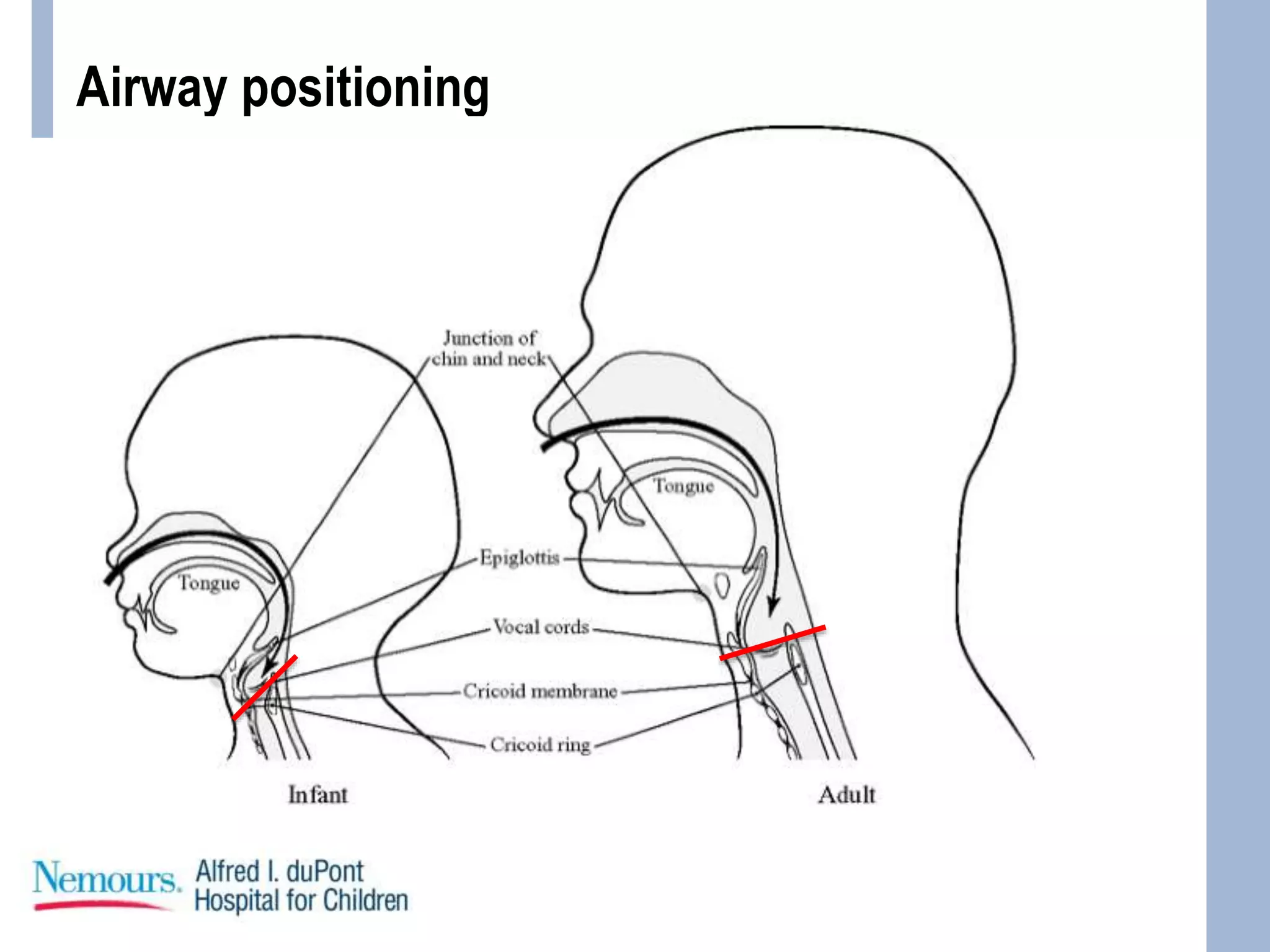 Pediatric intubation | PPTX