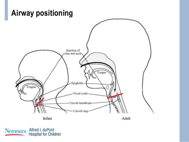 Nicu Intubation Vocal Cords