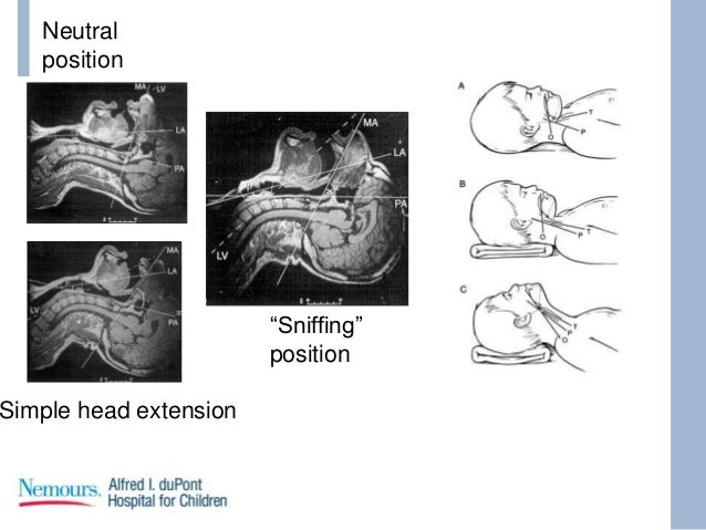 Pediatric intubation