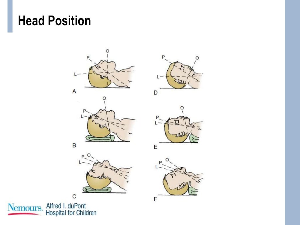 Pediatric intubation
