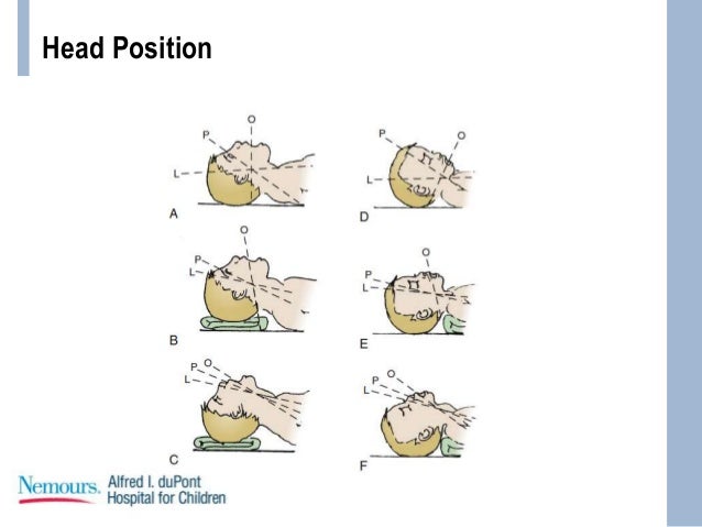 Pediatric intubation