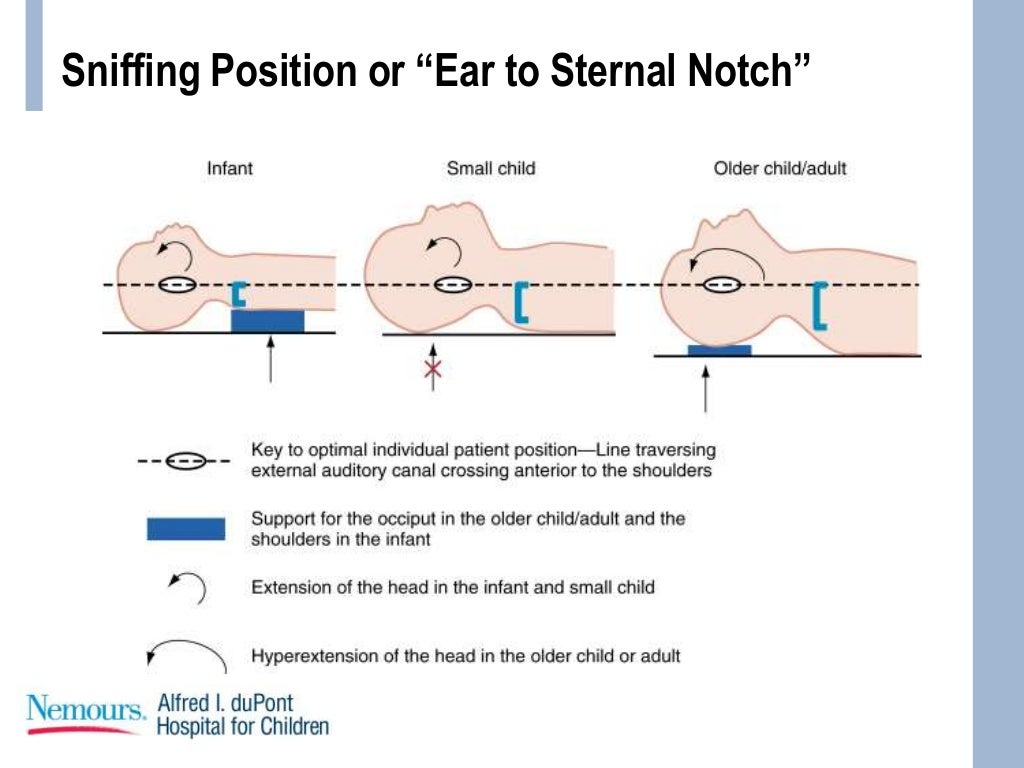 Pediatric intubation