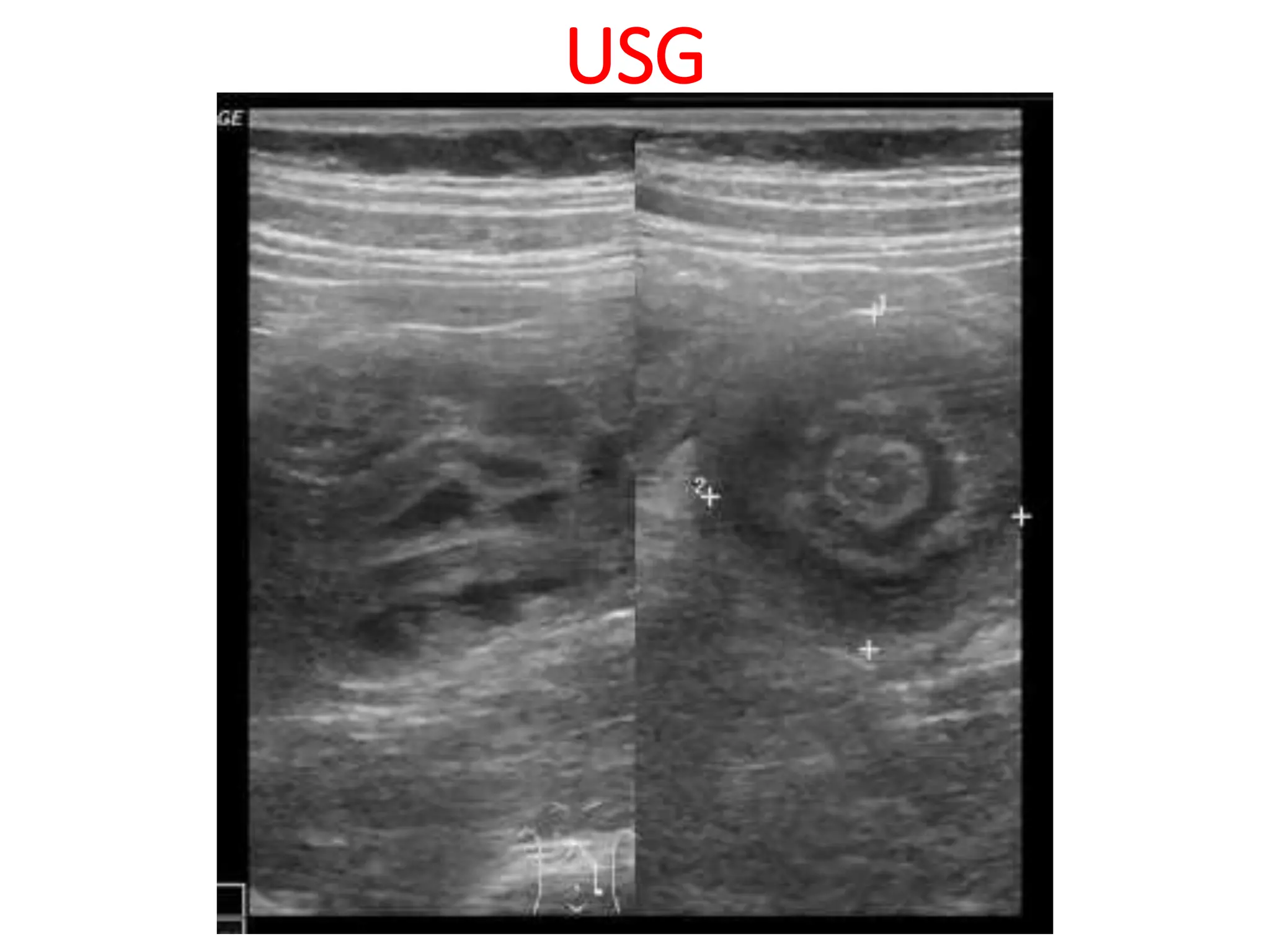 Pediatric Intussusception | PPTX