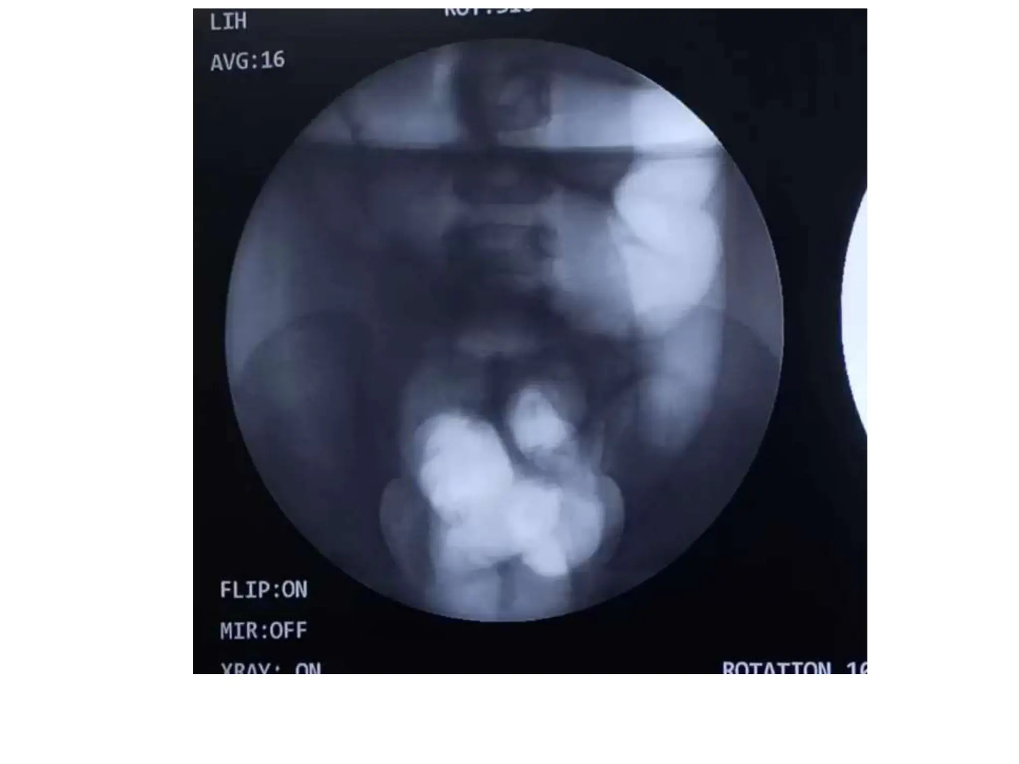 Pediatric Intussusception | PPTX