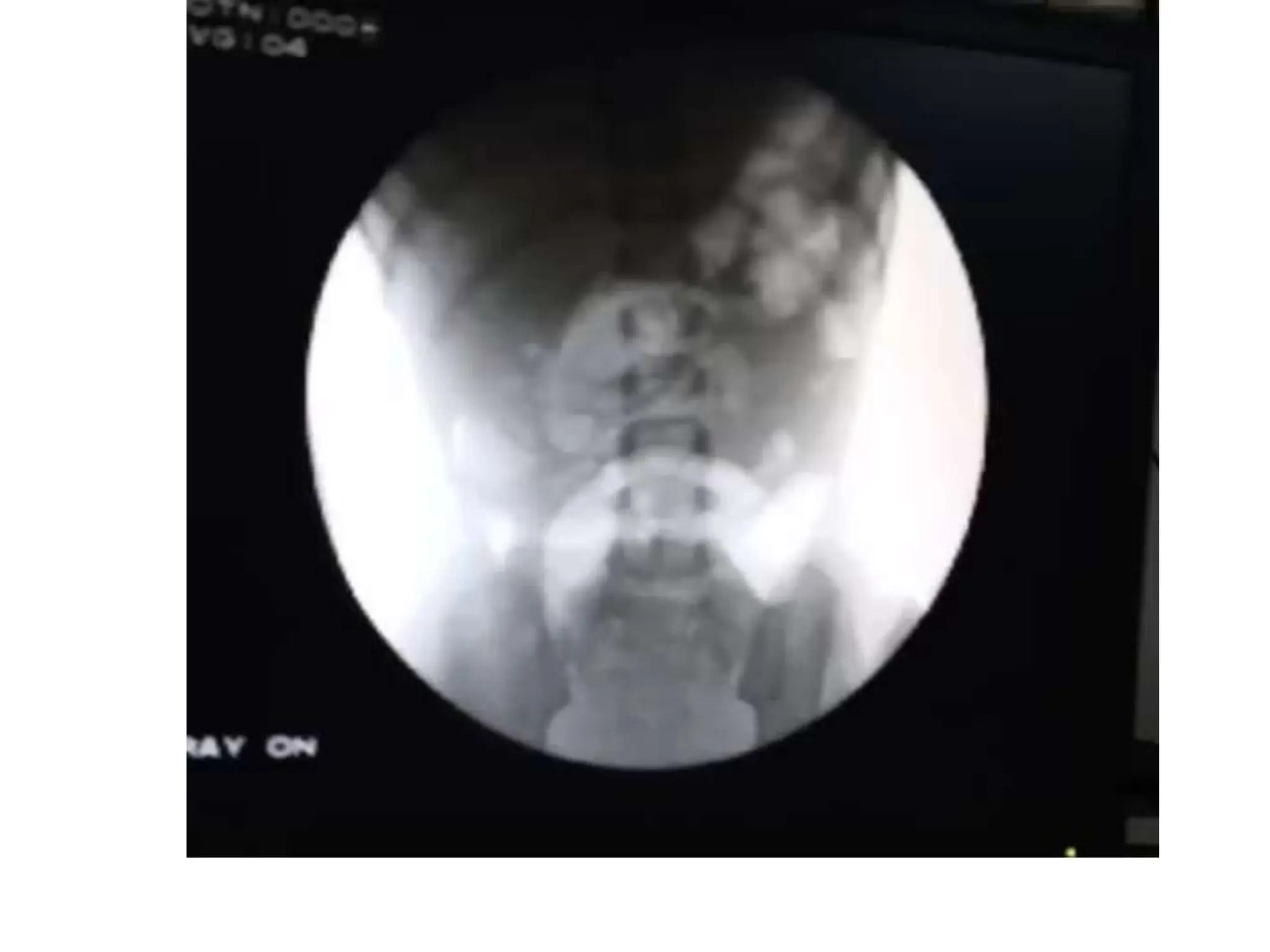 Pediatric Intussusception | PPTX