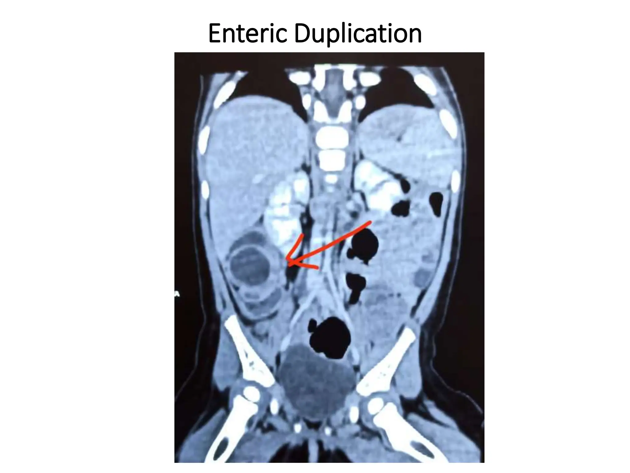 Pediatric Intussusception | PPTX
