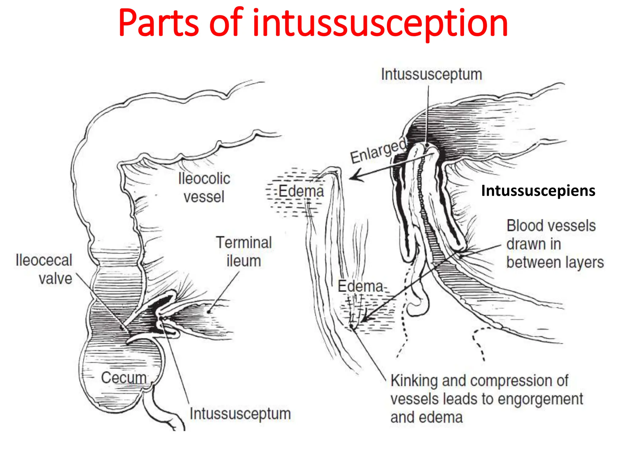 Pediatric Intussusception | PPTX