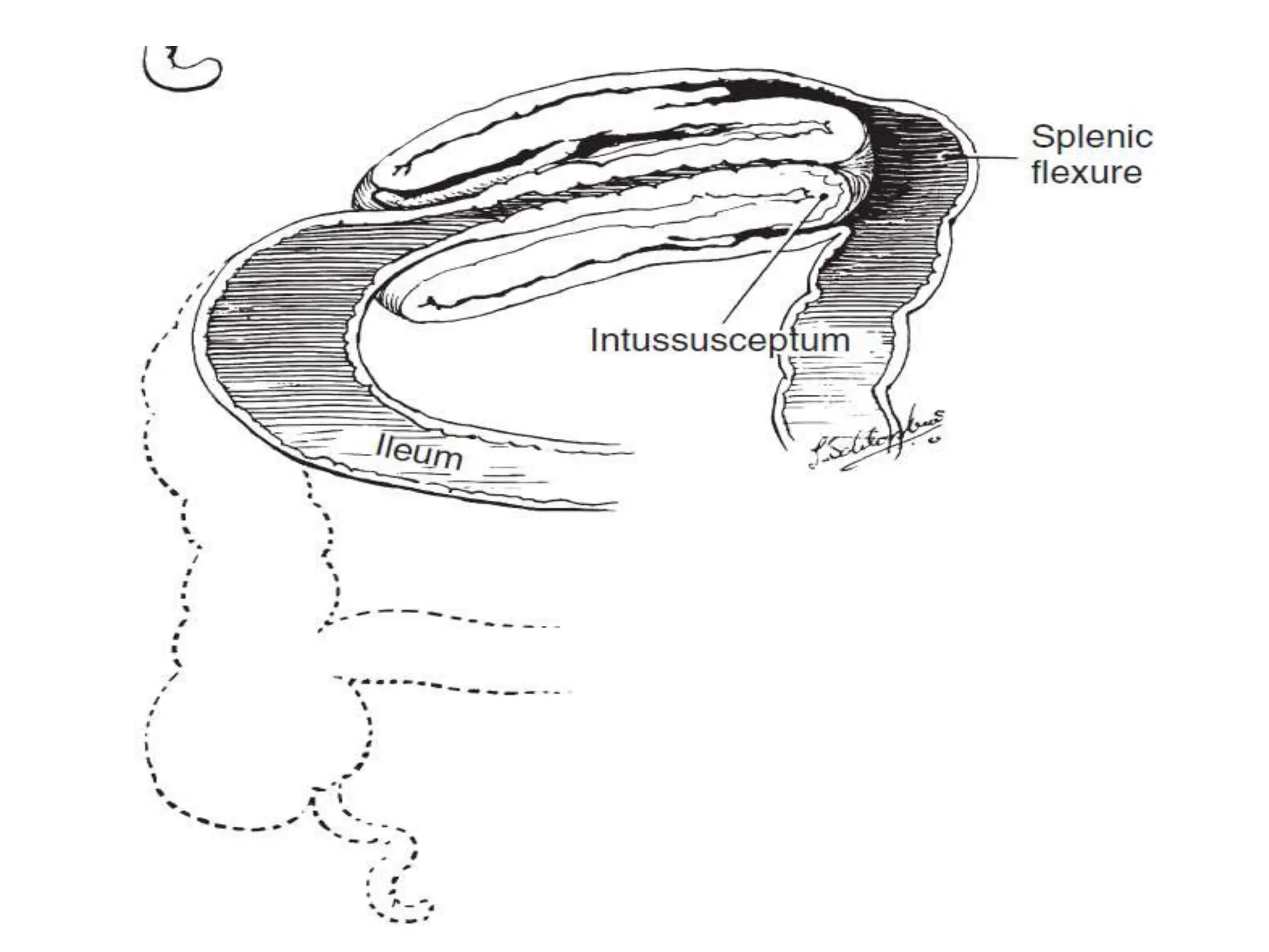 Pediatric Intussusception | PPTX