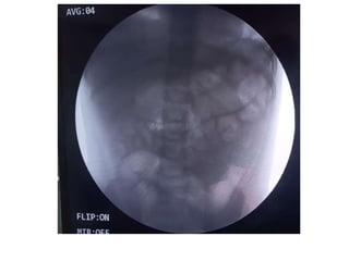 Pediatric Intussusception | PPTX