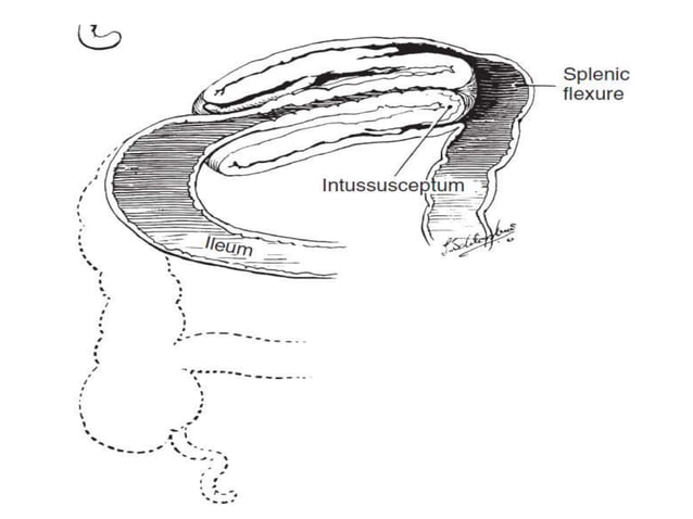 Pediatric Intussusception | PPTX