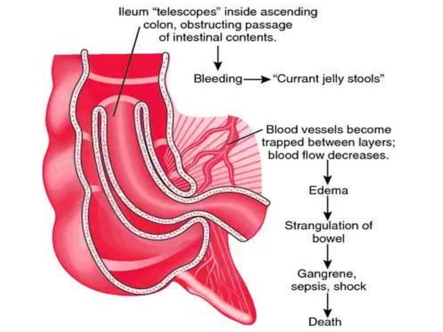 Pediatric Intussusception | PPTX