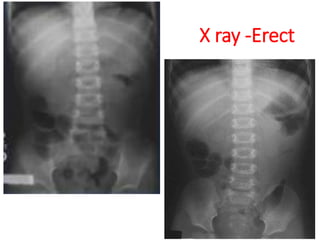 Pediatric Intussusception | PPTX
