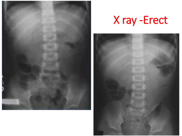 Pediatric Intussusception | PPTX