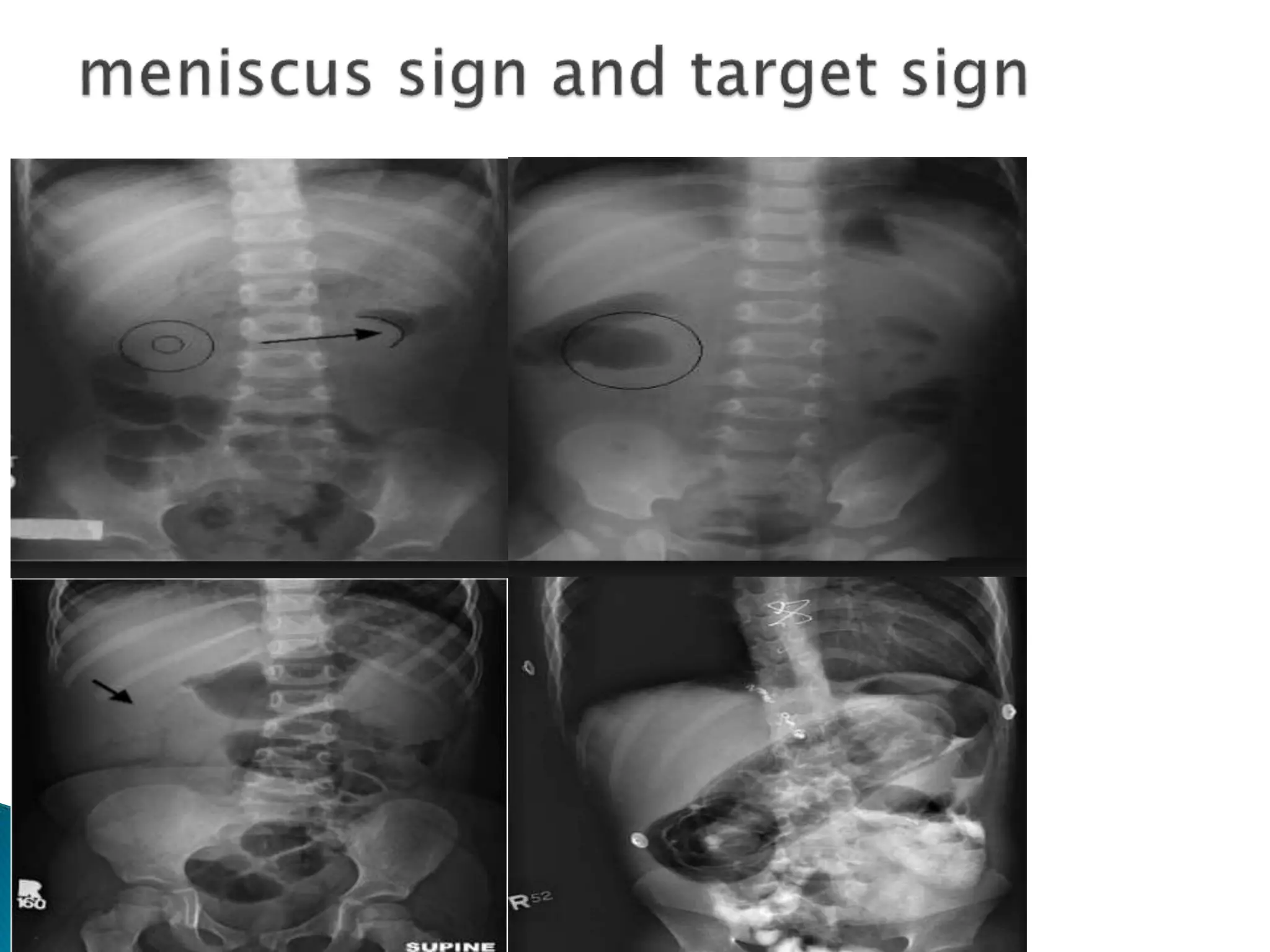 Pediatric intussusception final | PPTX