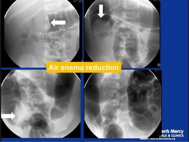 Pediatric intussusception final