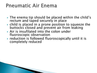Pediatric intussusception final | PPTX