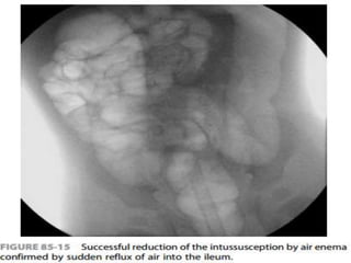 Pediatric intussusception final | PPTX