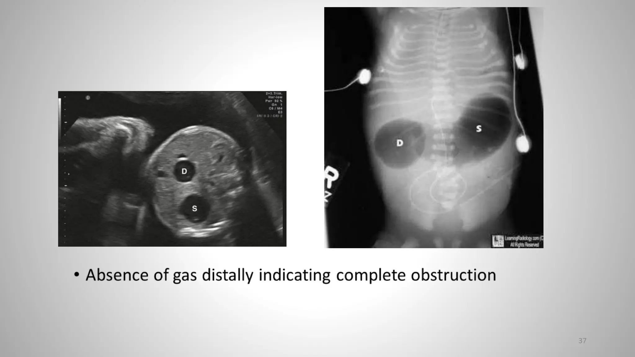 Imaging in Paediatric Intestinal Obstruction | PPTX | Pregnancy ...