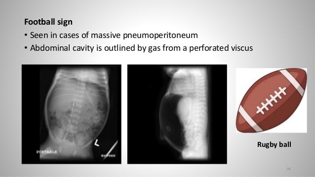 Imaging in Paediatric Intestinal Obstruction