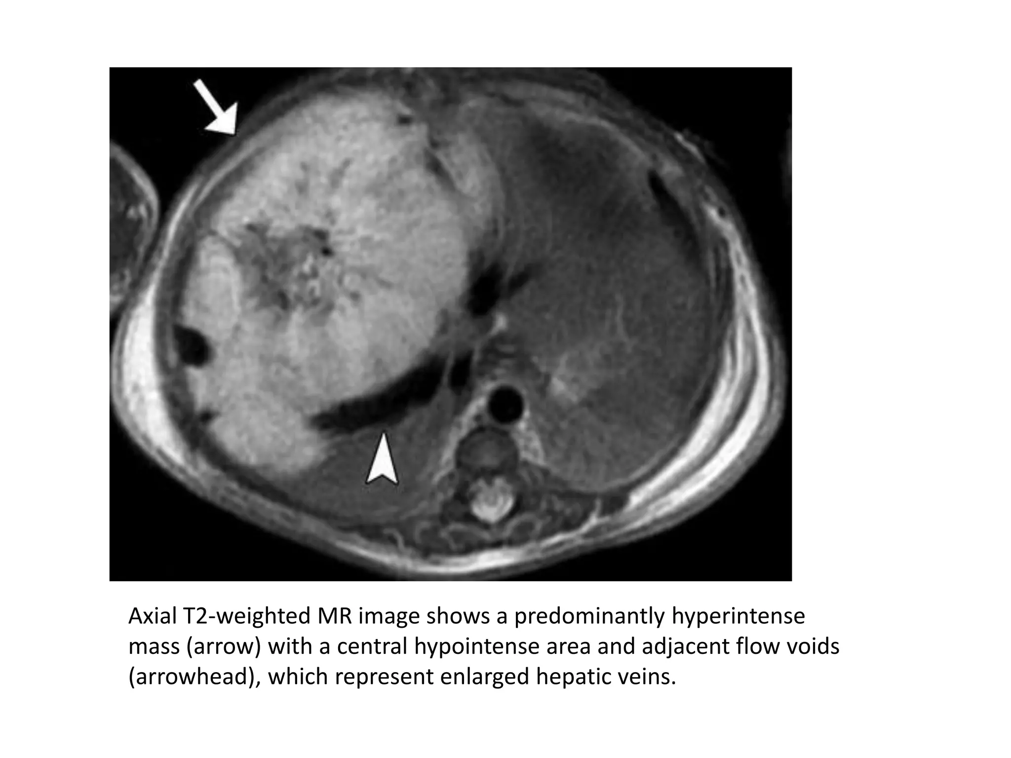 Pediatric liver masses | PPTX