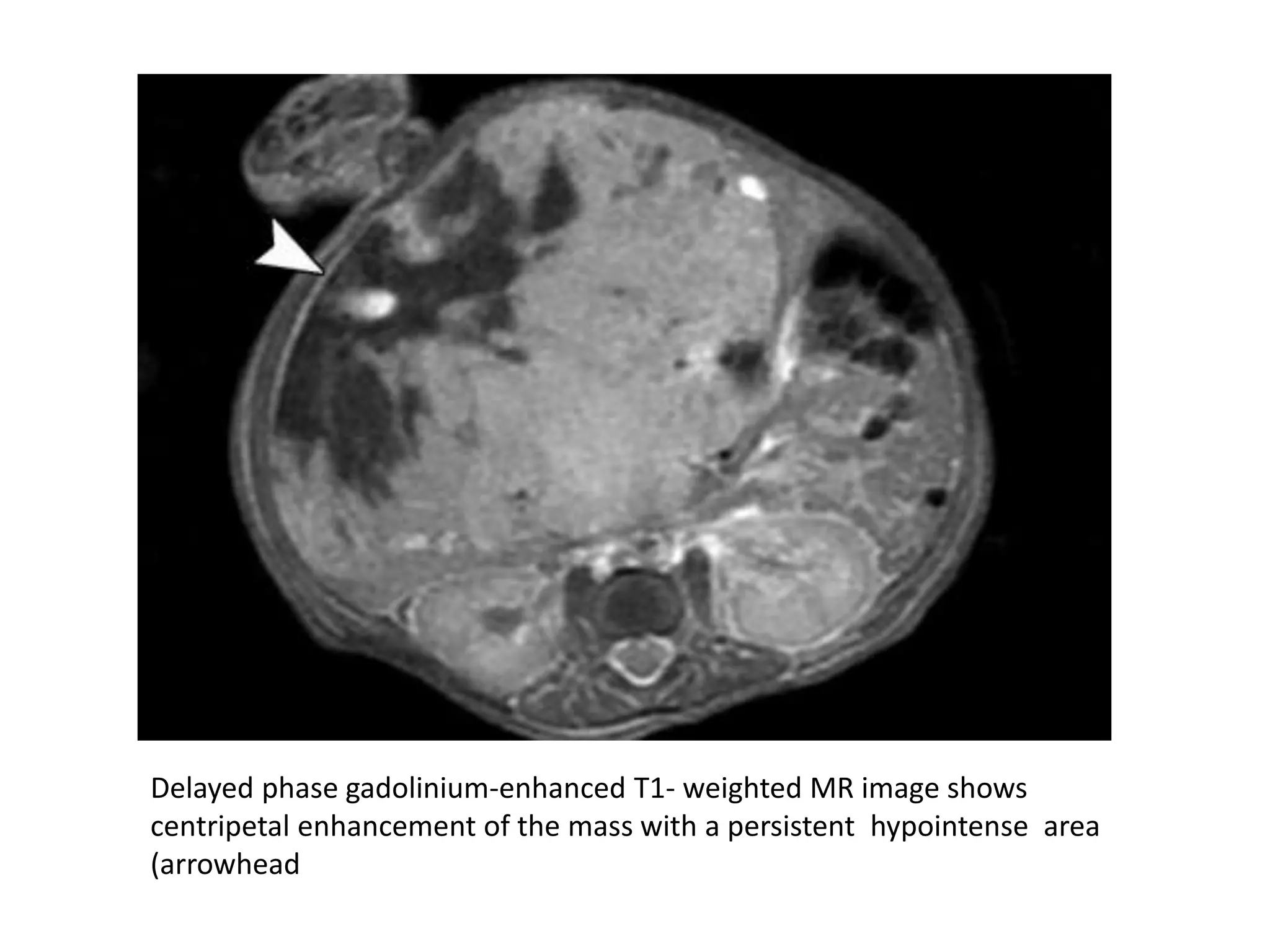 Pediatric liver masses | PPTX