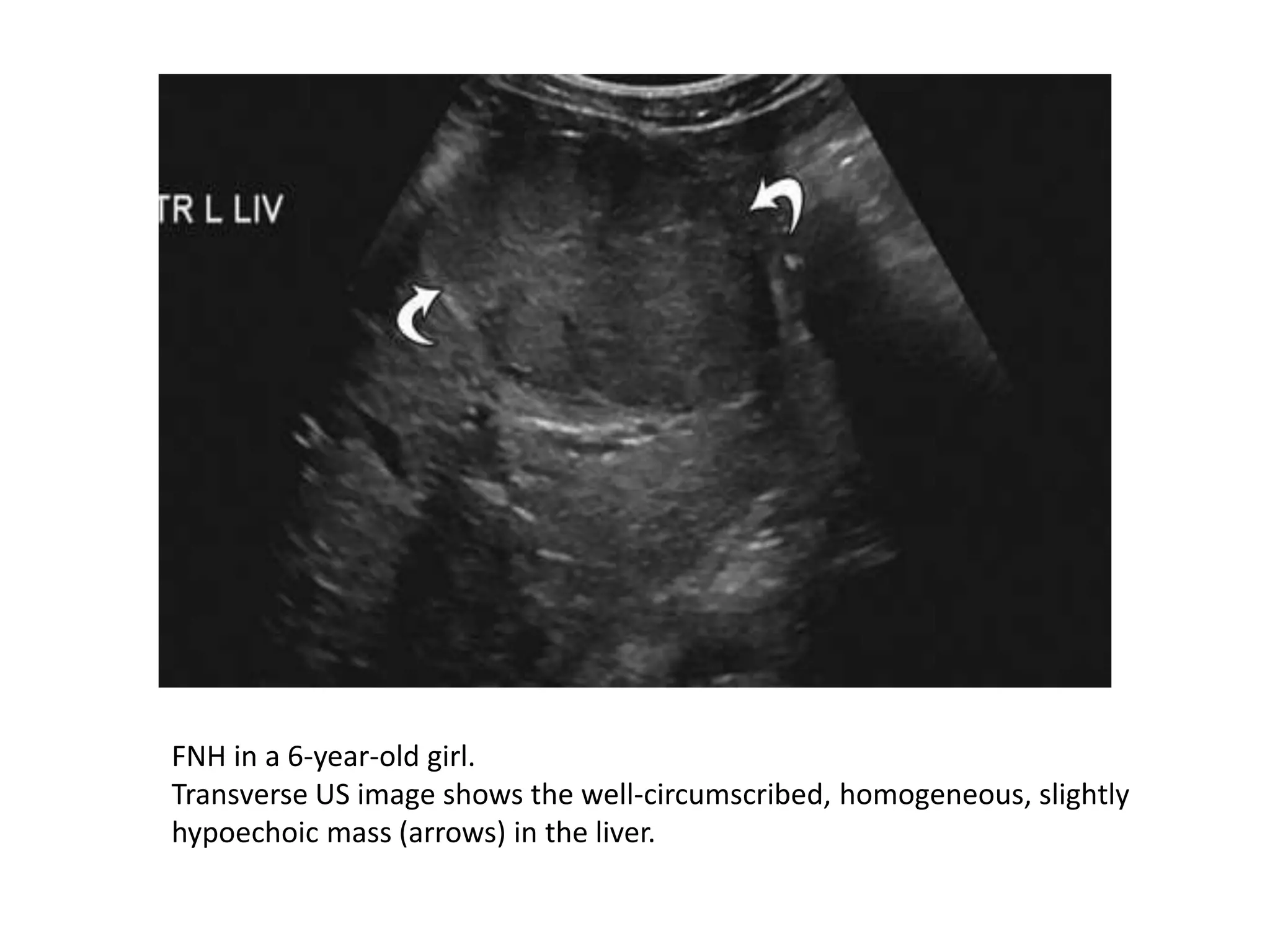 Pediatric liver masses | PPTX