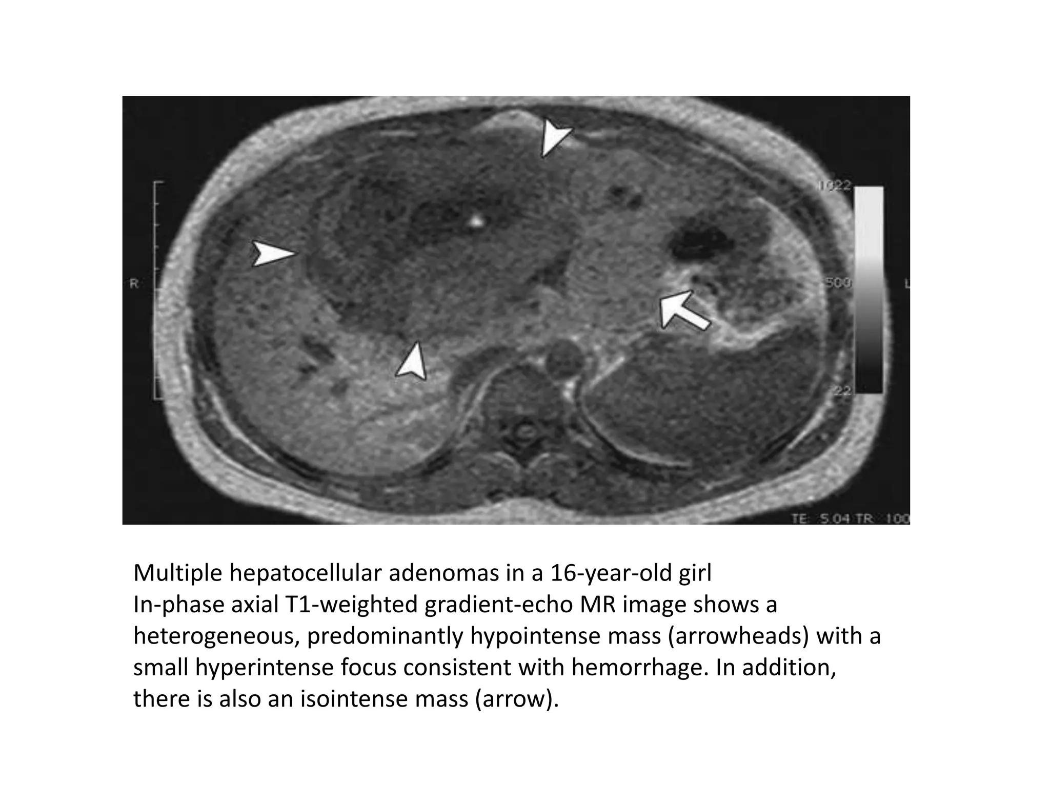 Pediatric liver masses | PPTX
