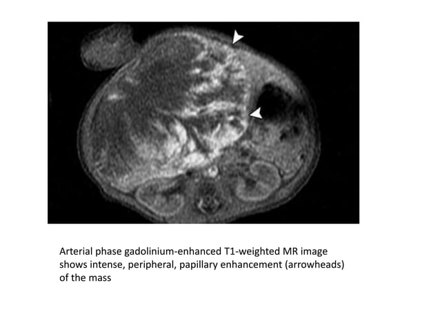 Pediatric liver masses | PPTX | Blood Disorders | Diseases and Conditions