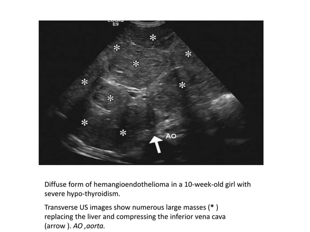Pediatric liver masses | PPTX | Blood Disorders | Diseases and Conditions