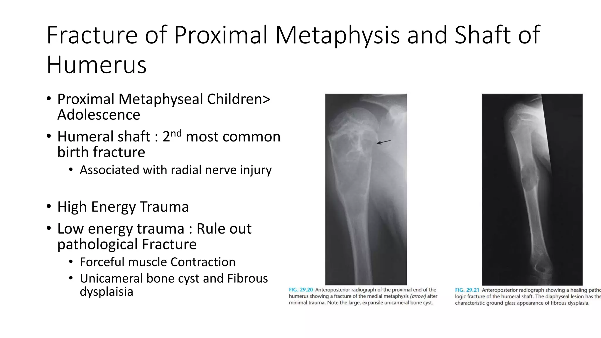 Pediatric Long Bone Fractures.pptx