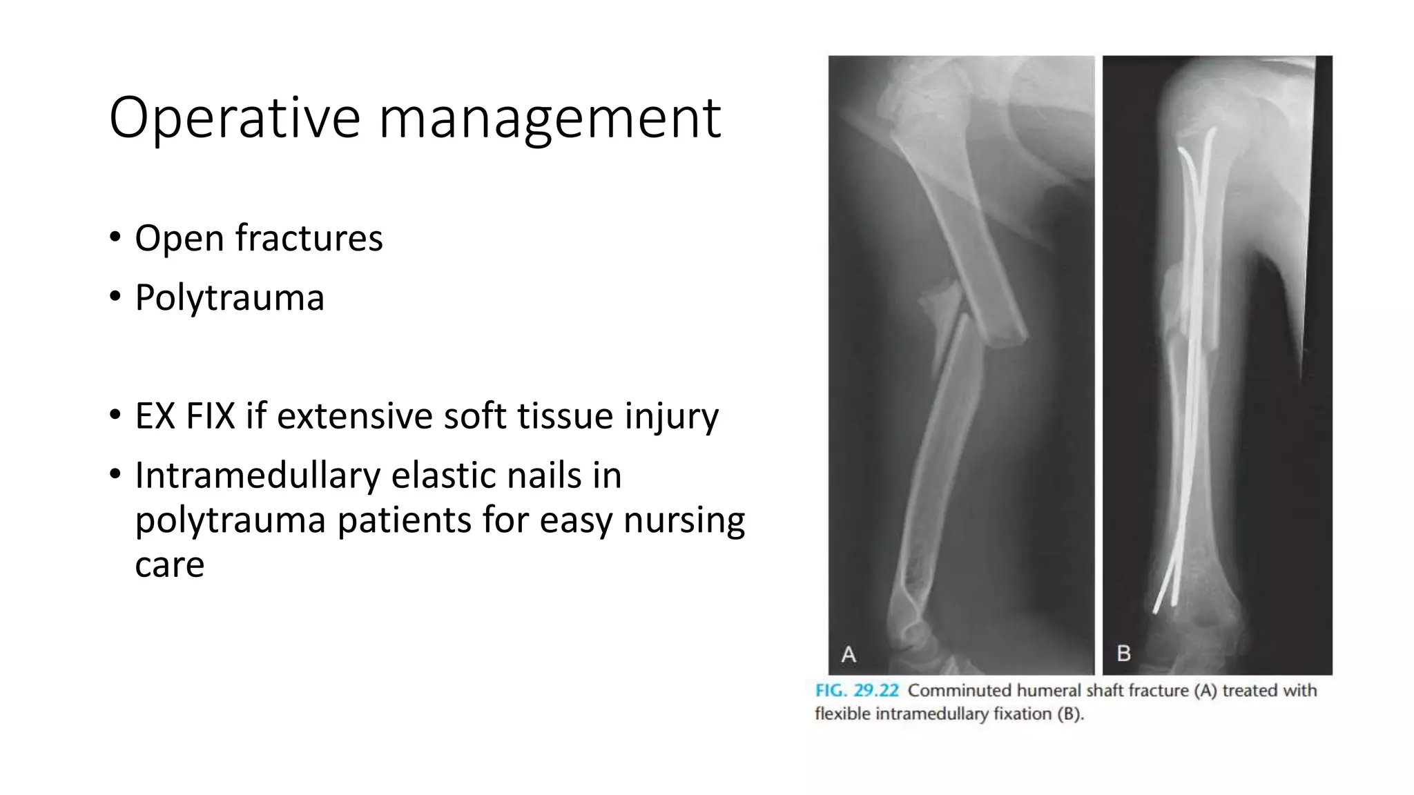 Pediatric Long Bone Fractures.pptx