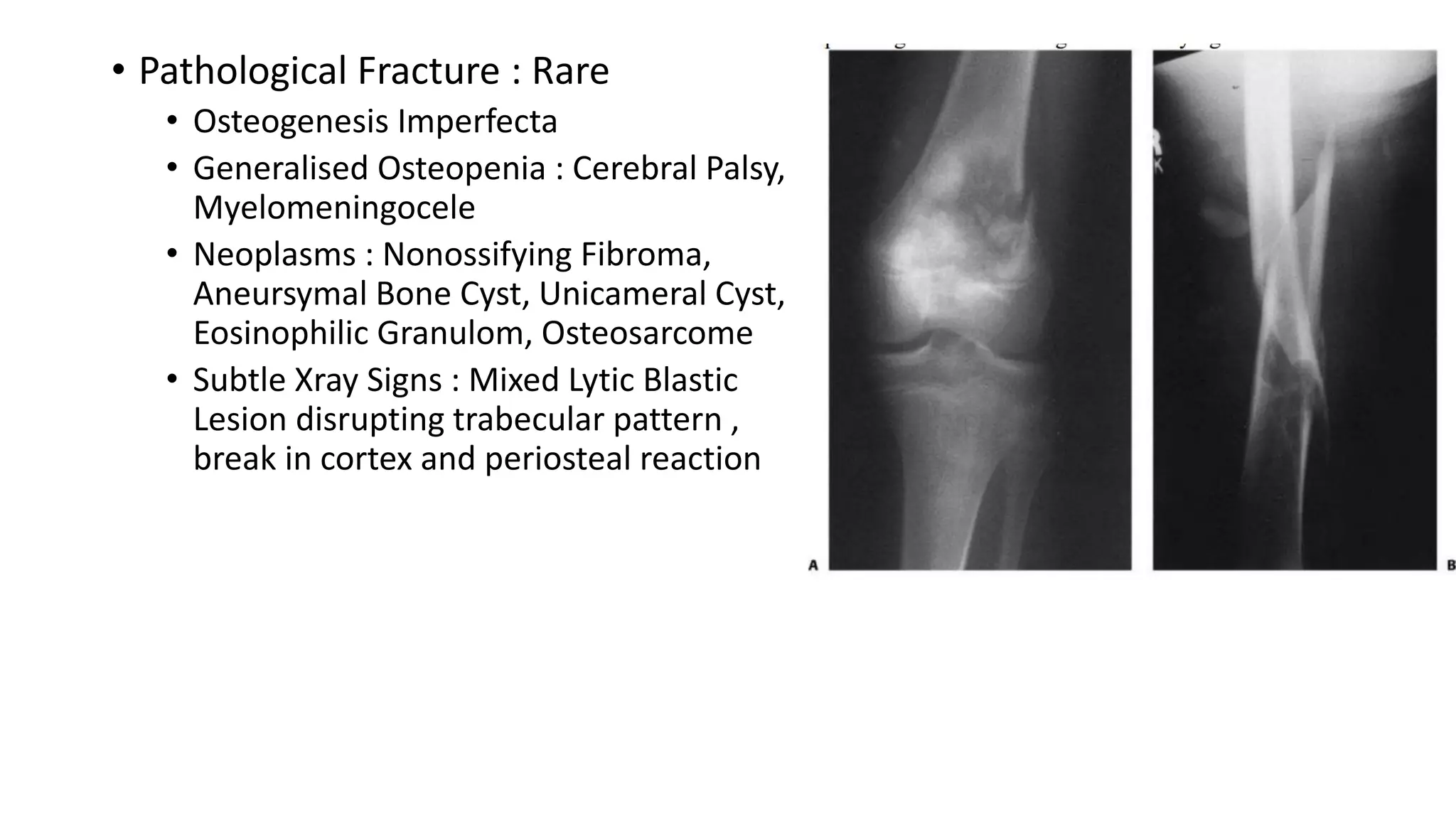 Pediatric Long Bone Fractures.pptx